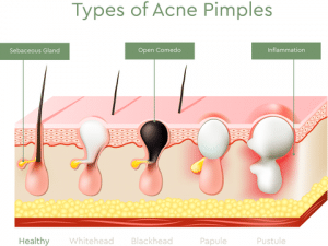 Acne Scar Treatments in Bloomfield / Hartford, Connecticut