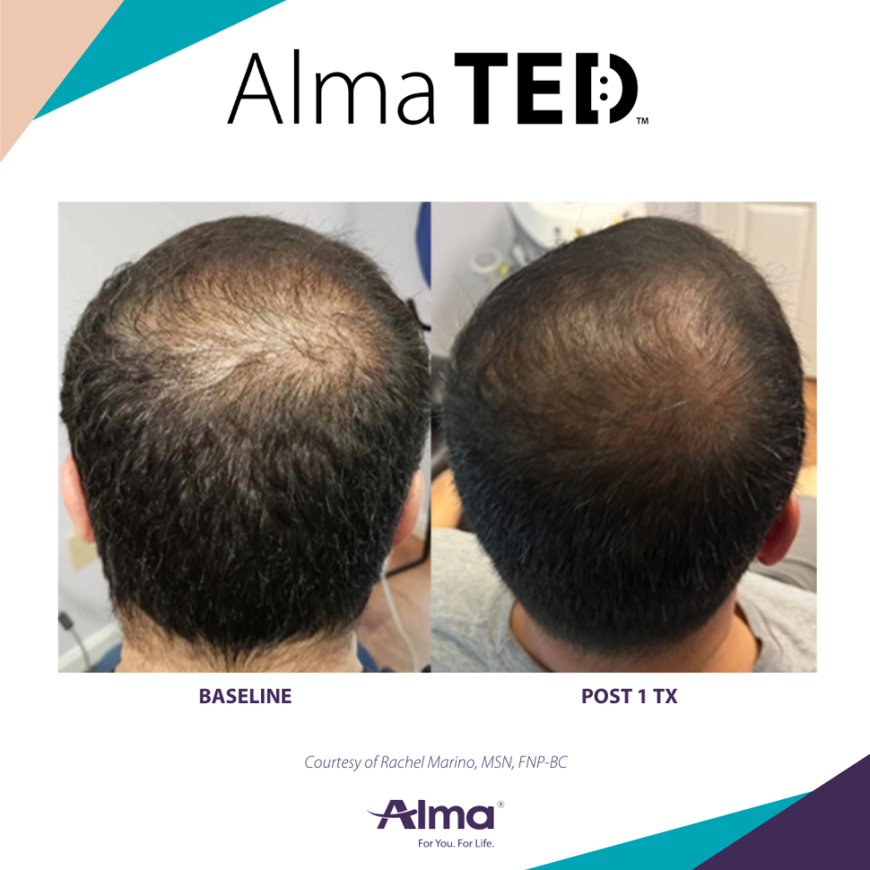 Alma TED Hair Restoration - Vivesse Med Spa
